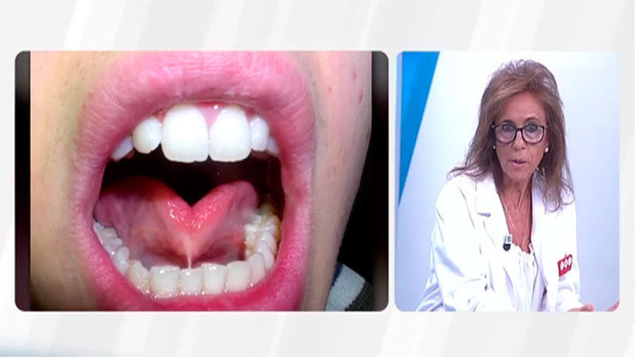 ¿Qué es la anquiloglosia?