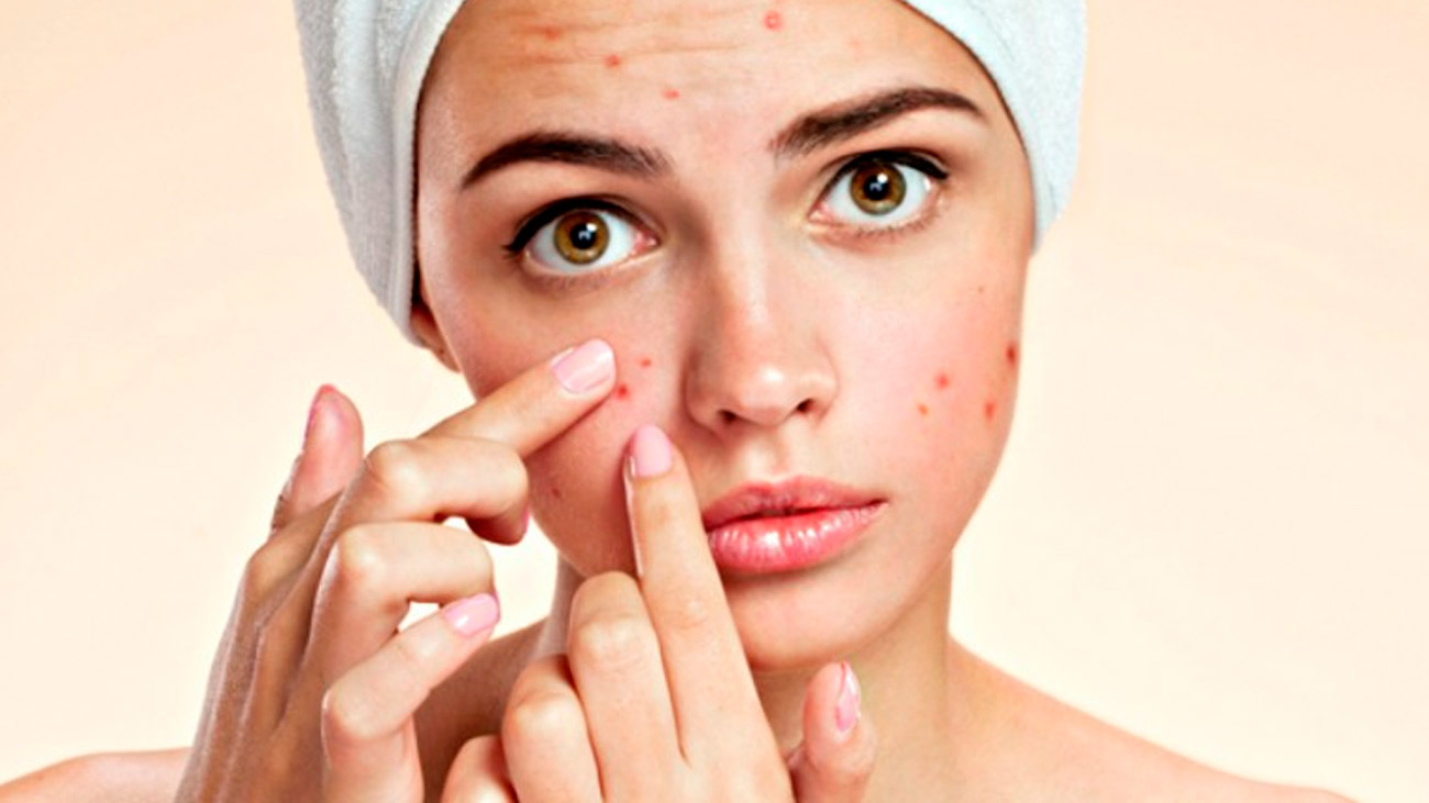El acné no solo es un problema de adolescentes